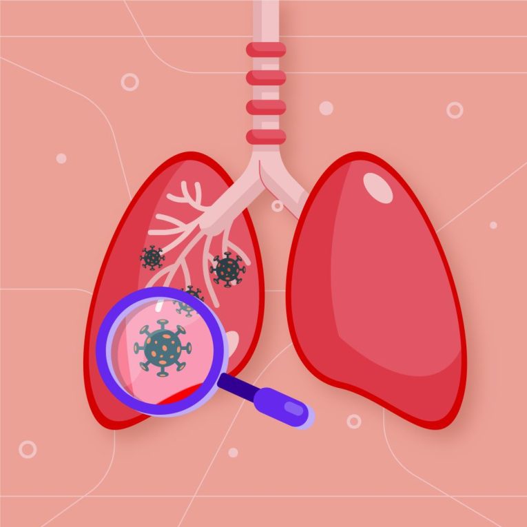 Understanding Pneumonia: Symptoms, Causes, and Effective Treatments for ...