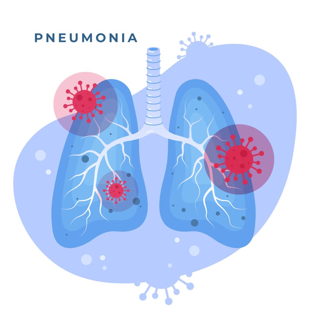 Understanding Pneumonia: Symptoms, Causes, and Effective Treatments for ...