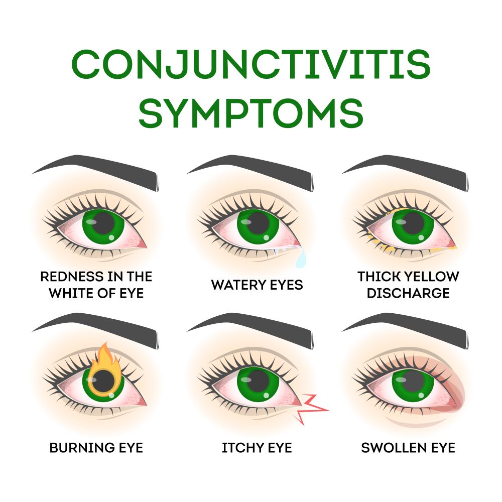 The Complete Guide to Pink Eye (Conjunctivitis)