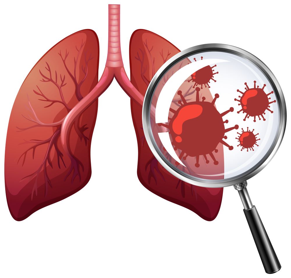 The Impact of Human Metapneumovirus (HMPV) on Respiratory Health