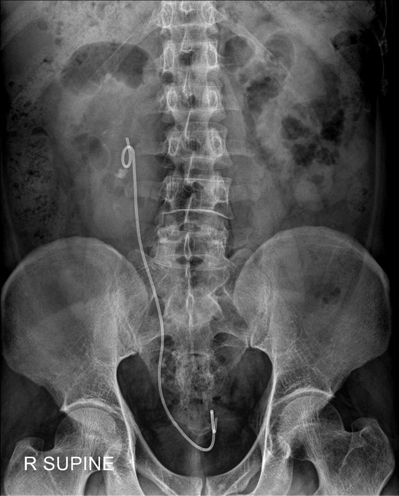 Kidney Stones Explained: Things to Know for Better Health