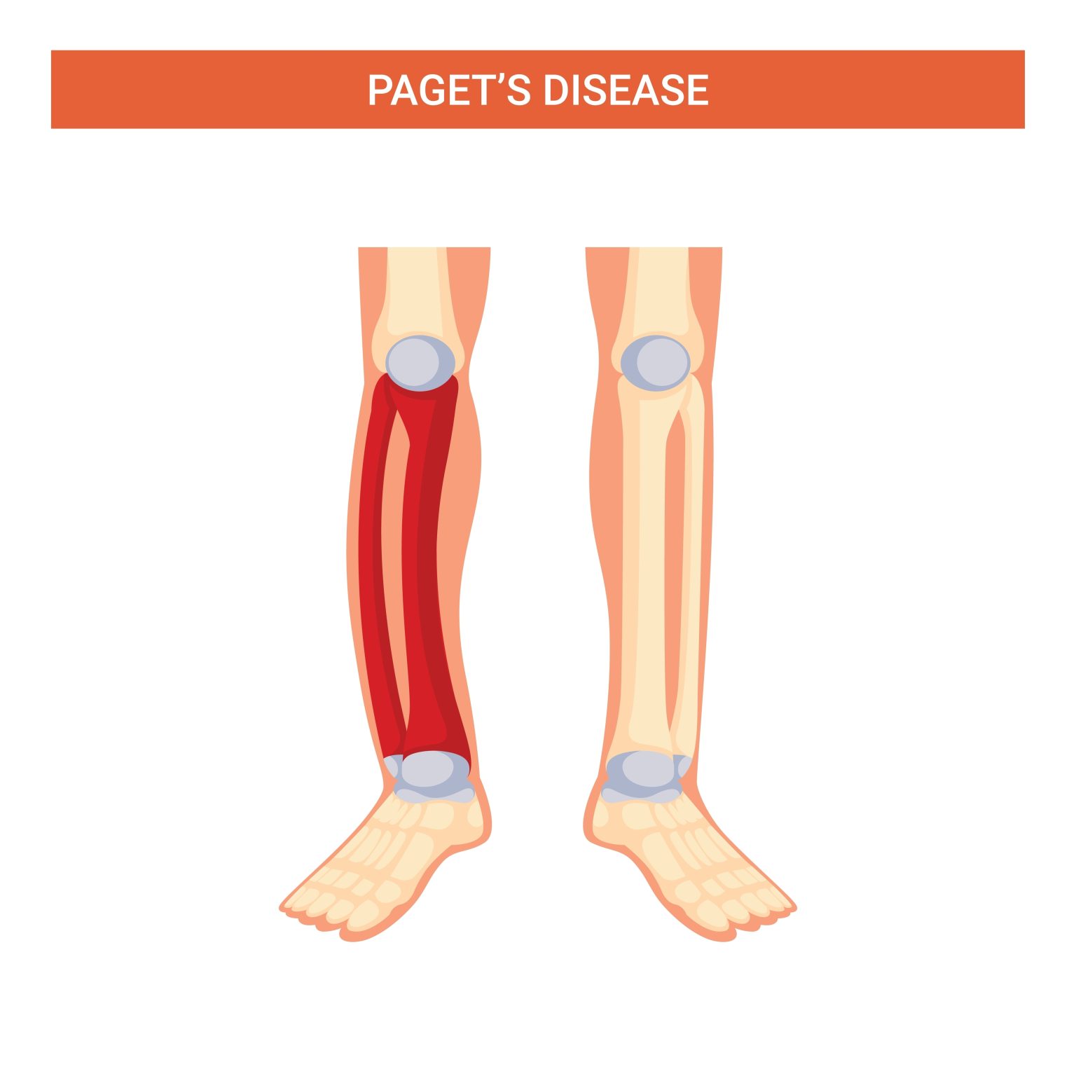Navigating Paget's Disease of Bone: An In-Depth Look at This Condition