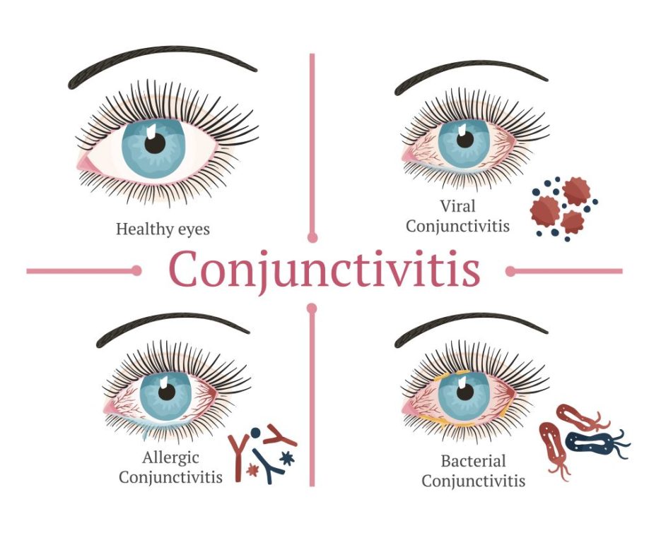 The Complete Guide to Pink Eye (Conjunctivitis)