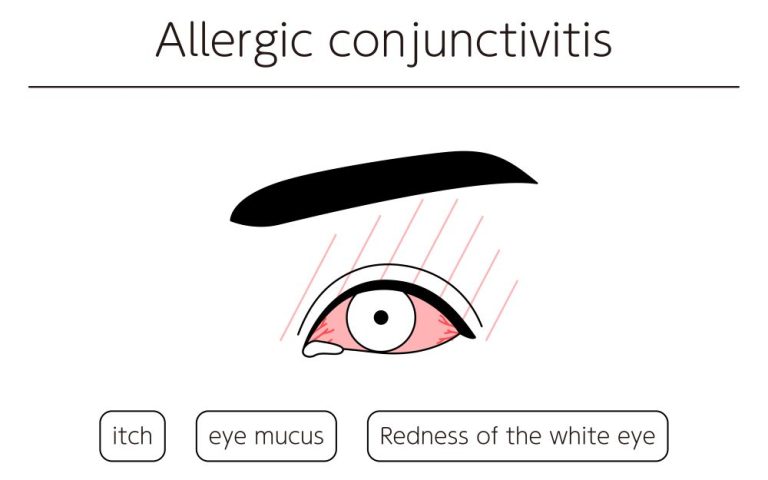 The Complete Guide to Pink Eye (Conjunctivitis)