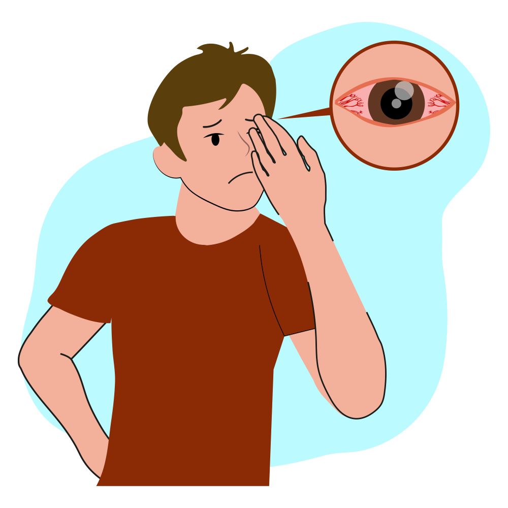 The Complete Guide to Pink Eye (Conjunctivitis)