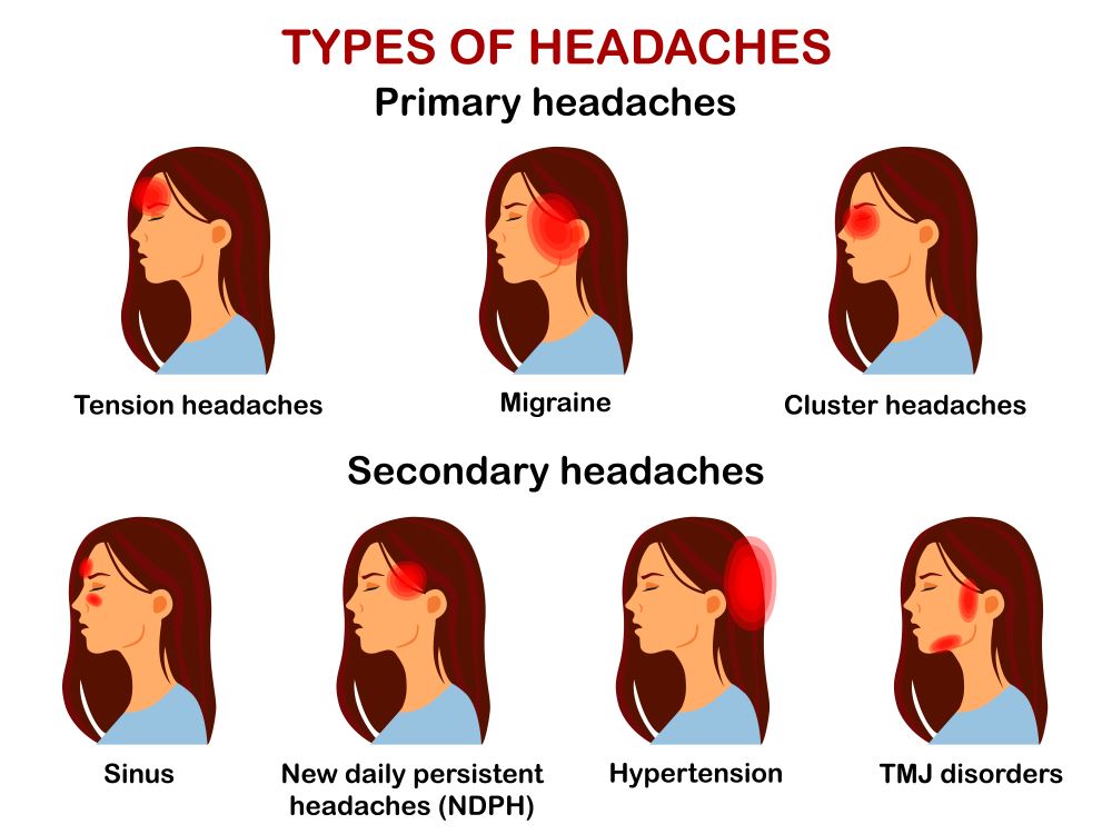 Migraine: Understanding Causes, Symptoms, and Relief Tips