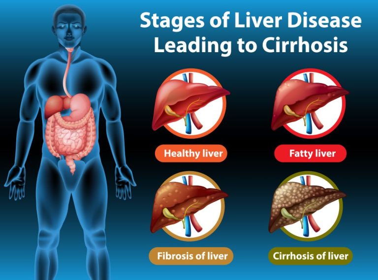 Liver Cirrhosis: Causes, Symptoms, Diagnosis & Treatment