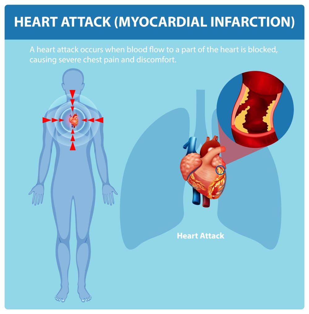 Heart Attack Symptoms: What You Need to Know