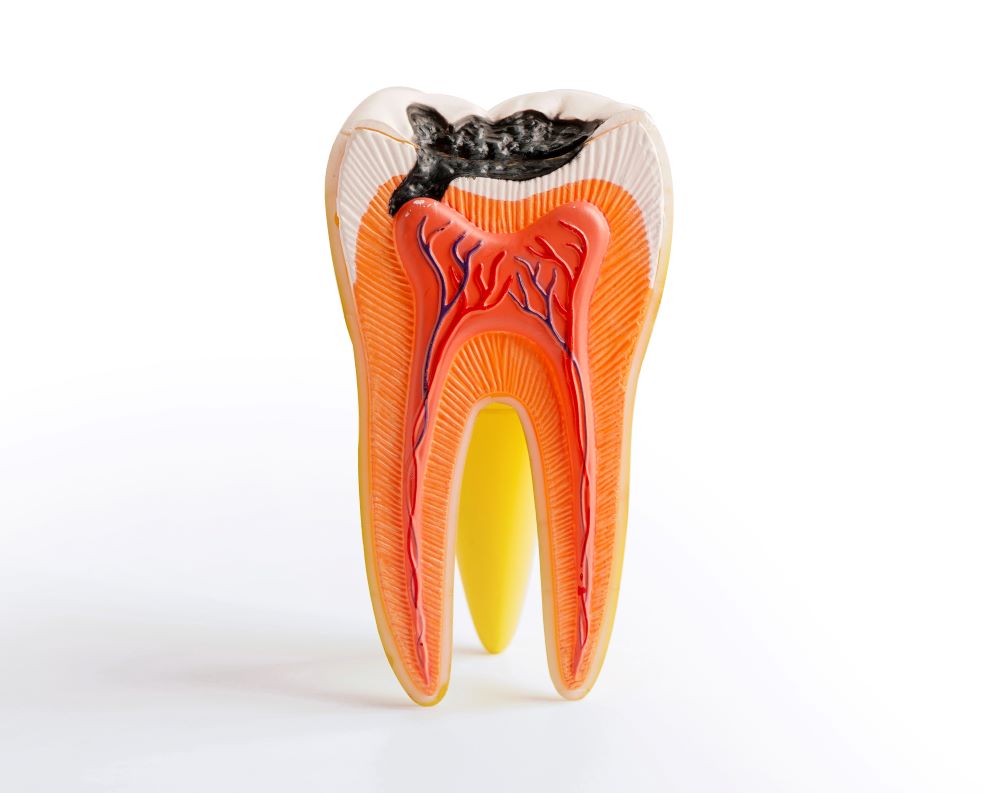 The Role of Oral Bacteria in the Development of Dental Caries