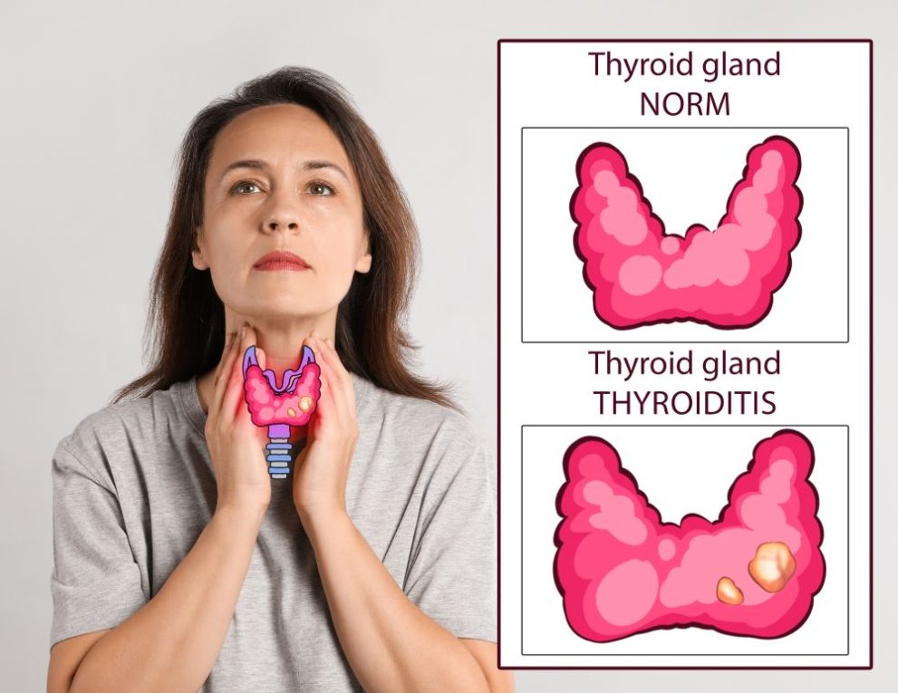 Hyperthyroidism: Symptoms, Causes, and Treatment