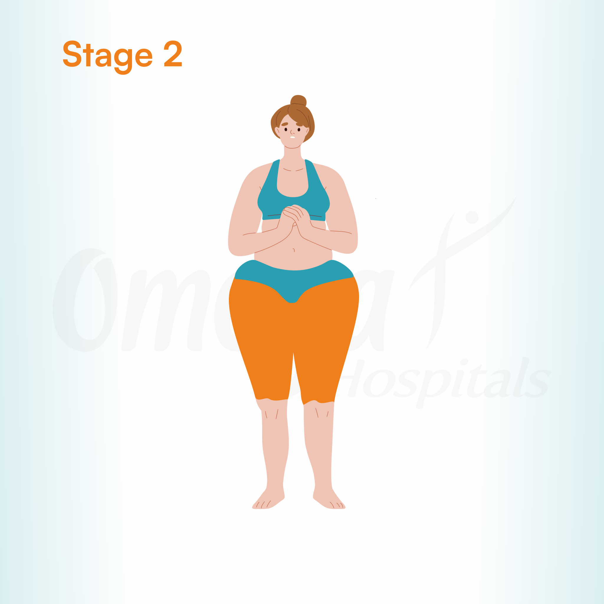 Lipedema Stages Explained | Symptoms & Treatment Guide