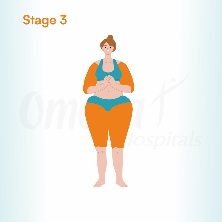 Lipedema Stages Explained | Symptoms & Treatment Guide