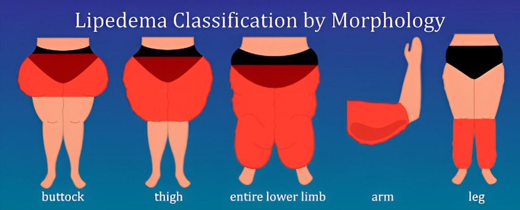 Lipedema Stages Explained | Symptoms & Treatment Guide