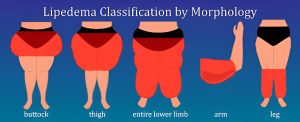 Lipedema Stages Explained | Symptoms & Treatment Guide