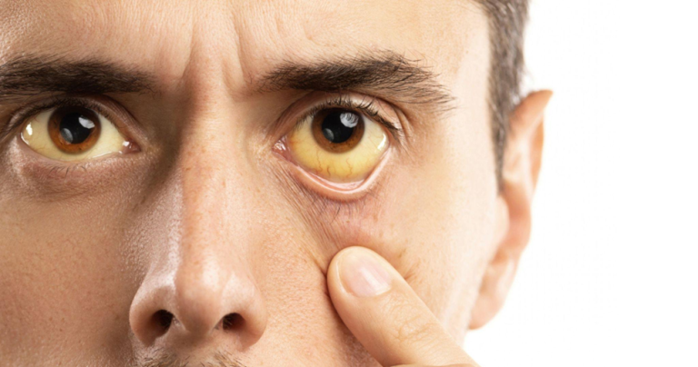 Understanding Hepatitis E: Causes, Symptoms, Treatment & Prevention