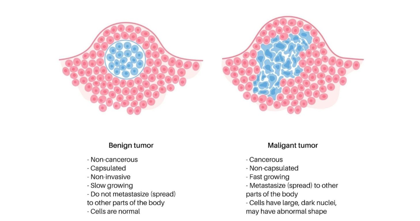 Benign Tumors Explained: Key Facts and Insights You Should Know