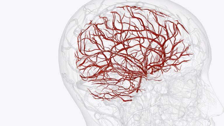 Cerebral Arteriovenous Malformations: Causes, Risks, and Treatment ...
