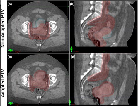 Ethos Linac (AI-Powered) | Radiation Therapy | Omega Hospitals