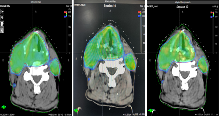 Ethos Linac (AI-Powered) | Radiation Therapy | Omega Hospitals