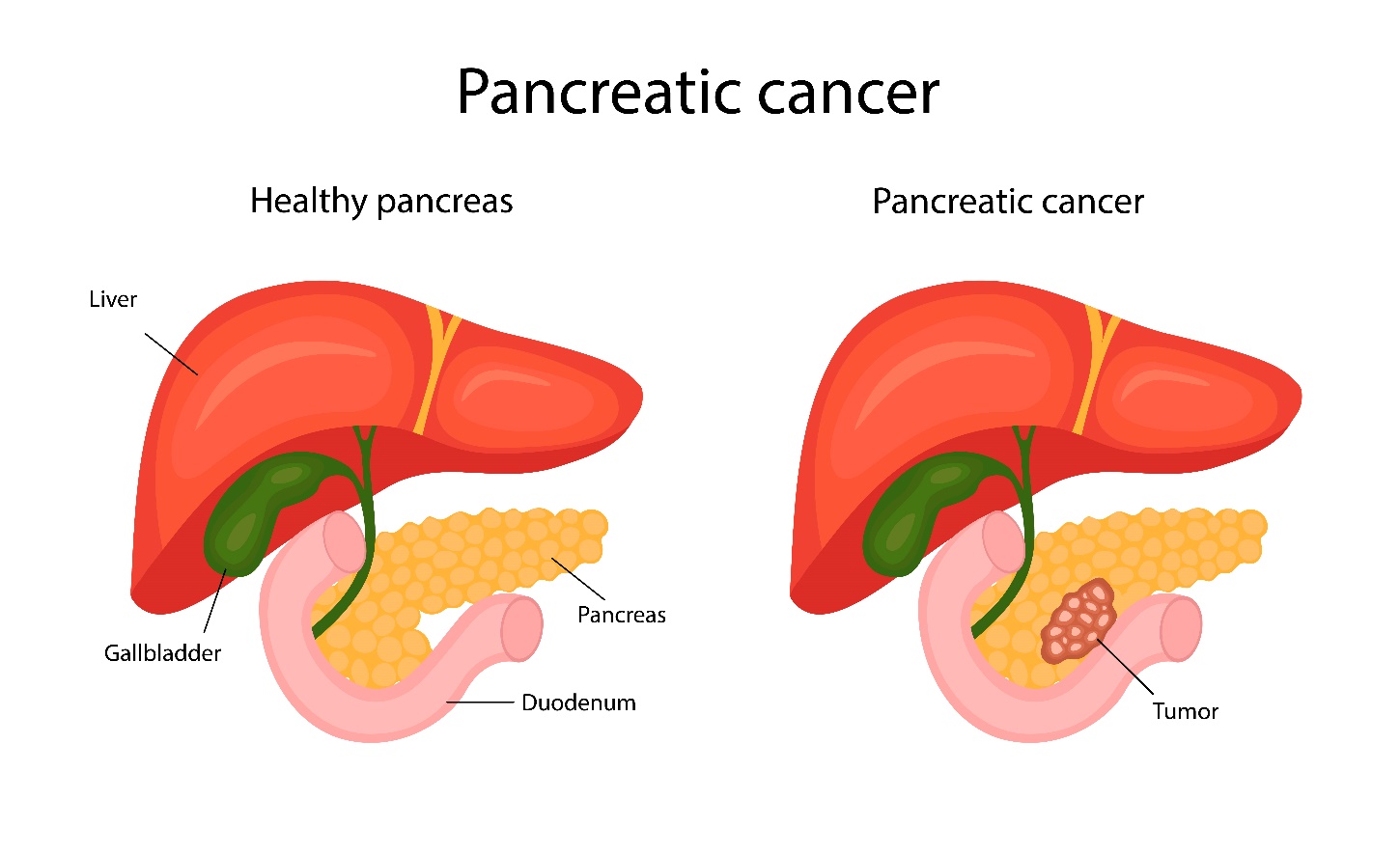 Understanding the Symptoms and Treatments to Pancreatic Cancer | Omega ...